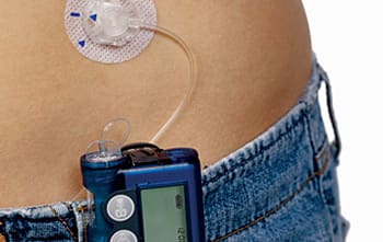 Continuous Subcutaneous Insulin Infusion in Long Term Care (CSII) for ...